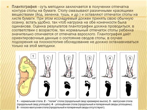 Плоскостопие. Виды плоскостопия - презентация онлайн