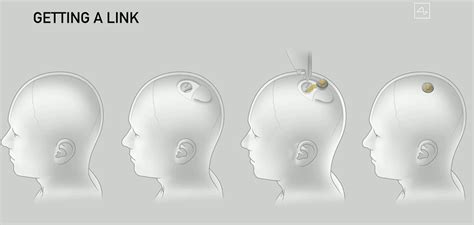 Neuralink Implant To Connect The Brain With Computers
