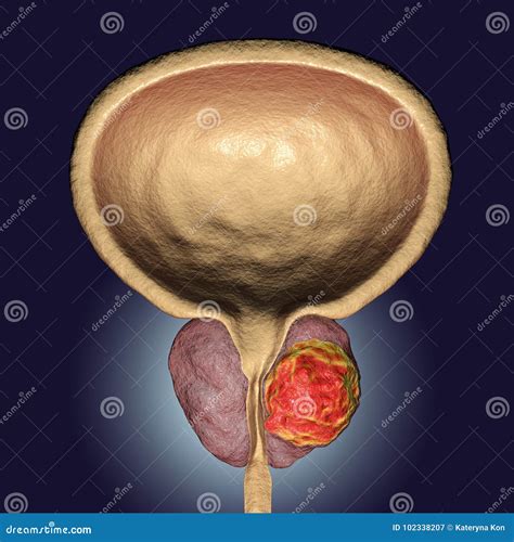 Prostate Cancer Banner Symptoms Causes Treatment Vector Signs For Web Graphics
