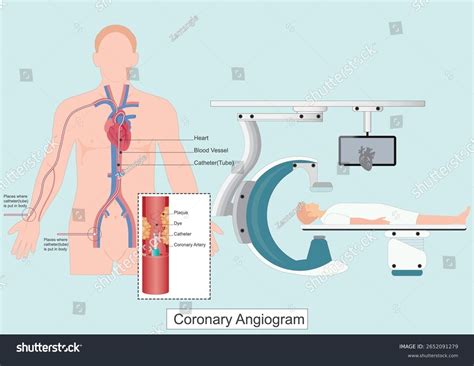 「冠動脈造影cagは、x線を使用して、x線透視装置（cアームまたはバイプレーンcath Lab）によって心臓の血管を見るための検査です。医療