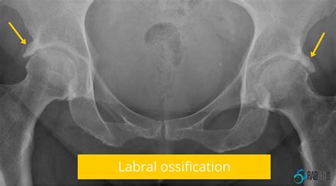 Hip Mri Show Me The Xray Acetabular Rim Ossifications How To Make Sense Of Them Radiology