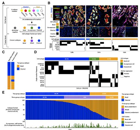 Spatially Resolved Single Cell Assessment Of Pancreatic Cancer Expression Subtypes Reveals Co