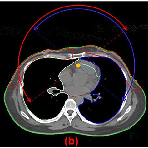 Beam Arrangements And Isocenter Positions Yellow Star For A