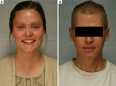 Transoral Thyroid And Parathyroid Surgery Via The Vestibular Approach—a 2020 Update Pmc
