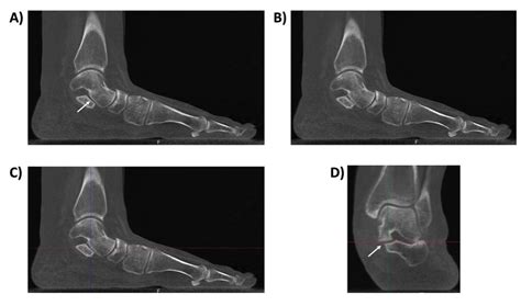 The Journal Of Bone And Joint Surgery Inc On Linkedin Subluxation Of The Middle Facet Of The