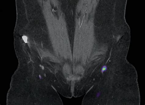 Single Photon Emission Computed Tomographic Reverse Lymphati