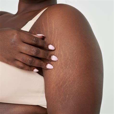 Causes Of Stretch Marks Laser Treatment For Stretch Marks