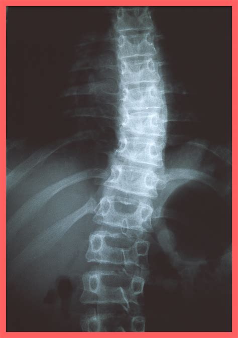 소아 척추측만증이 의심되거나 진단받았다면 건강검진정보