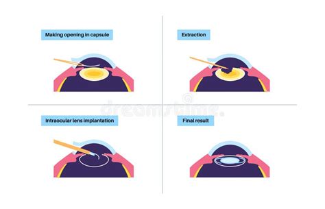 Cataract Surgery Poster Stock Vector Illustration Of Blindness 331577937