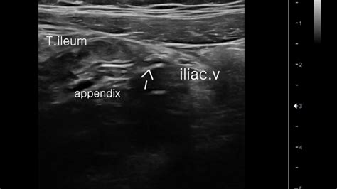 Ultrasound For Pediatric Appendicitis Hqmededcom