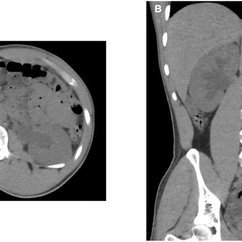 Left Retrograde Pyelogram Revealing Stenosis Of The Left Distal Ureter Download Scientific
