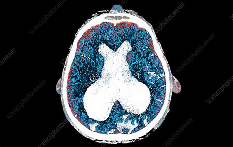 Hydrocephalus Ct Scan Stock Image C056 1201 Science Photo Library