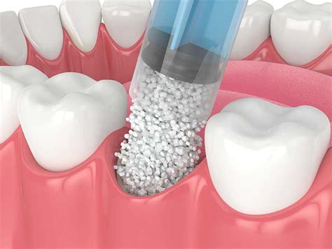 What To Expect From Bone Grafting For Dental Implants Implant Perio Center