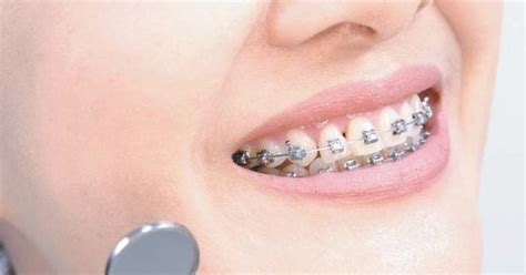 건강한 가족 치아 교정기 변형 막고 효과 오래가려면 ‘딱딱·질겅·끈적 피하세요