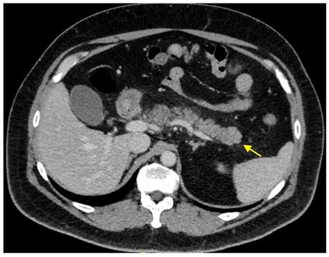 A Ct Scan Performed With Iodinated Contrast Media Demonstrated A Lesion