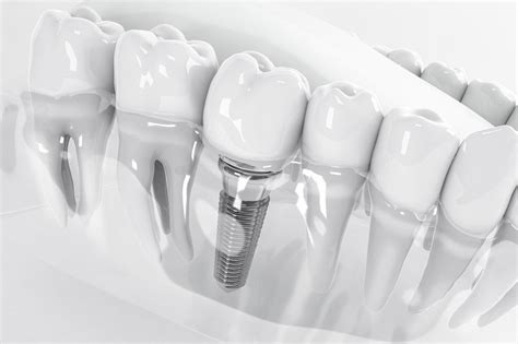 What Is Your Preference For Dental Implants Zaki Kanaan Johann Styger Posted On The Topic