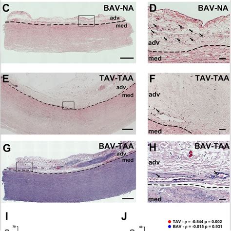 Chronic Inflammation In The Ascending Aortic Adventitia Of Aneurysmal Download Scientific
