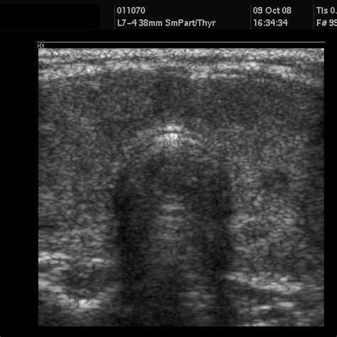 Female 31 Years Old Thyroid Enlargement And Multinodular Goiters