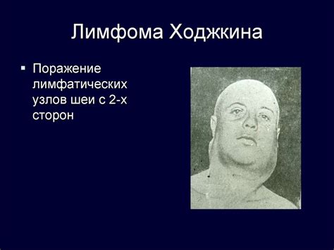 Опухоли системы крови и лимфоидной ткани презентация онлайн