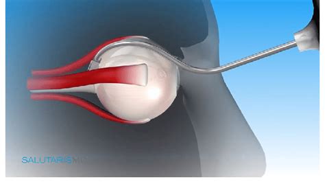 Episcleral Brachytherapy Device Introduced Via Subtenon Route To