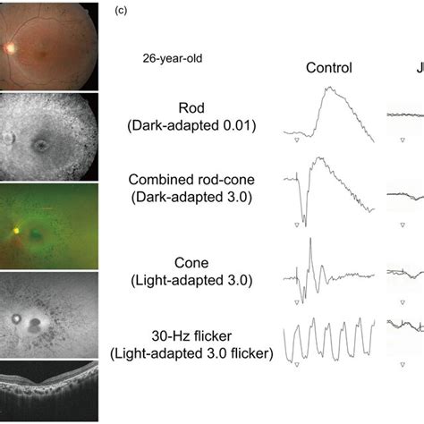 Multimodal Retinal Images And Full‐field Electroretinograms During The