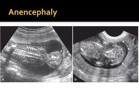 Congenital Brain Anomalies Pdf