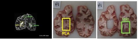 Post Mortem Mri Scanning Netherlands Brain Bank