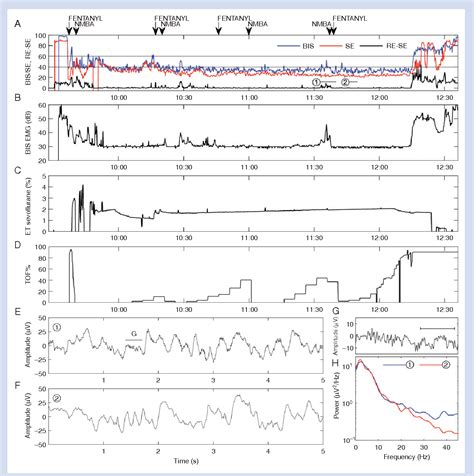 Figure 3 From Comparison Of Bispectral Index And Entropy Values With Electroencephalogram During