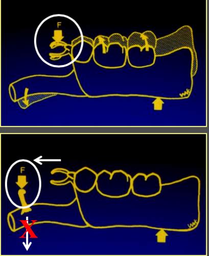 Session 2 Indirect Retainers And Tooth Replacement Flashcards Quizlet