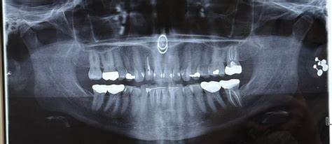 Panoramic X Ray A C Conventional 2d Radiography A Panoramic X Ray