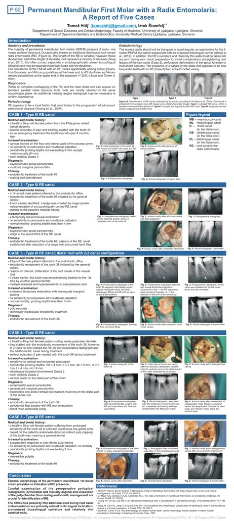 Pdf Permanent Mandibular First Molar With A Radix Entomolaris A Report Of Five Cases