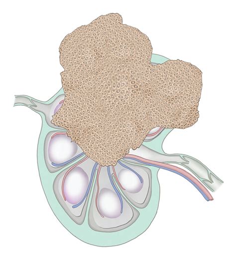 Radiologic Extranodal Extension Of Metastatic Lymph Nodes In Patients