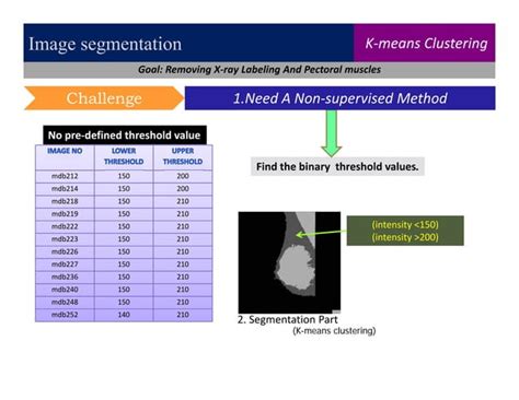 Microcalcification Identification In Digital Mammogram For Early