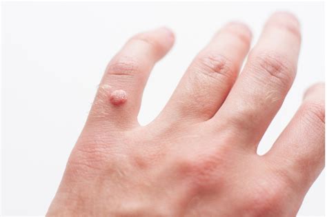 イボの手術 浦和の皮膚科いとう医院皮膚外科手術や自費診療にも対応さいたま市浦和区