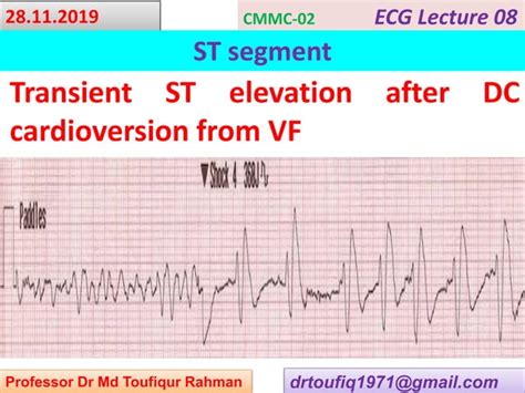 Ecg St Segment Ppsx