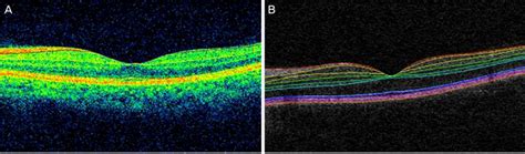 Representative Automatic Segmentation Results For A Normal Eye A