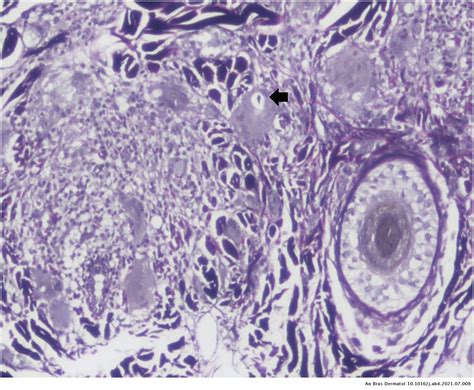 Dermoscopy Of Annular Elastolytic Giant Cell Granuloma Anais Brasileiros De Dermatologia