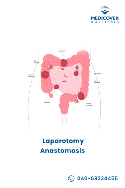 Anastomía Por Laparotomía Tipos Procedimiento Y Recuperación