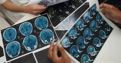 Remarkable Cancer Breakthrough Shows Woman S Brain Tumor Nearly Vanishes In Just Five Days