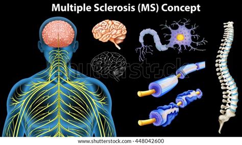 Diagram Showing Multiple Sclerosis Concept Illustration Stock Vector Royalty Free 448042600