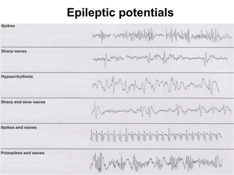 Diagrams Eeg Epilepsyppt