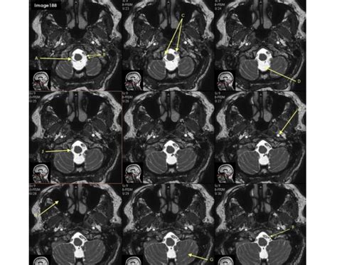 Cranial Nerves Mri Mriquiz 188 Quiz