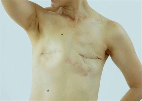 Lumpectomy Vs Mastectomy Making Your Decision