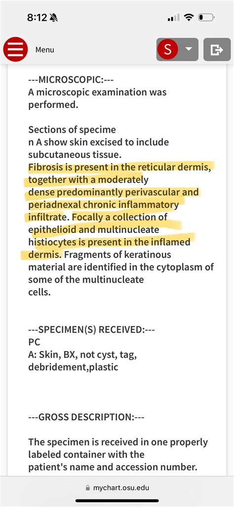 In Lieu Of Lip Biopsy Rsjogrens