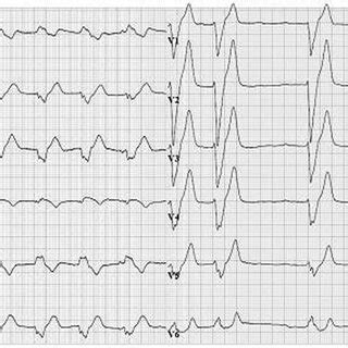 Atrial Fibrillation And Left Bundle Branch Block Download Scientific Diagram