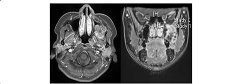 Magnetic Resonance Imaging Showing Diffuse Mass With The Contrast Download Scientific Diagram