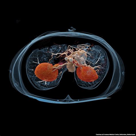 Siemens Healthineers On Linkedin Naeotom Alpha Photon Counting Ct