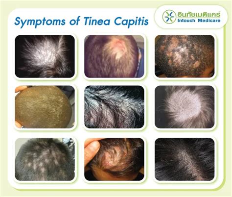 Tinea Capitis Symptoms Causes And Treatment Intouchmedicare