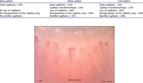 Definition Of Each Pattern Of Nvc Scleroderma Spectrum Abnormalities