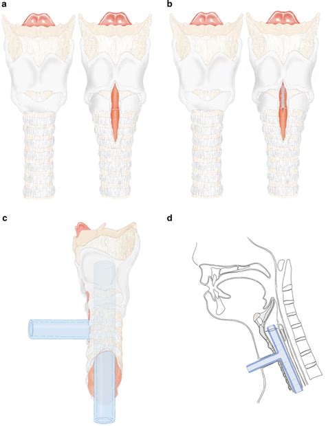Apc Split Procedure A The Anterior Midline Incision B The Posterior